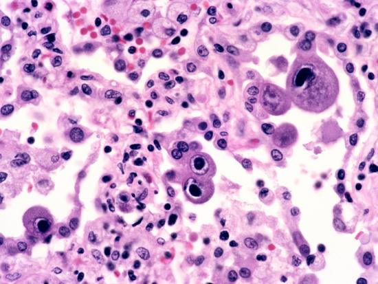 Cytomegalovirus, Cmv, Pneumonitis in the Lung, H&E Stain Photographic ...