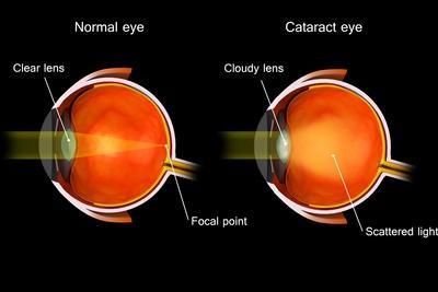 'Medical illustration of a cataract in the human eye, compared to a ...