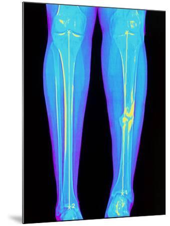 Coloured X-ray of Fractured Shin Bone (tibia) Photographic Print by ...